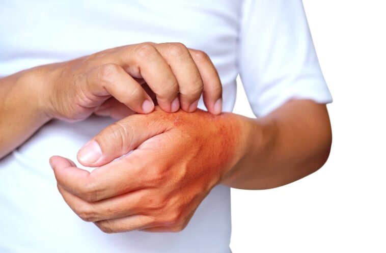 Common Signs Of Dermatitis You Should Know About